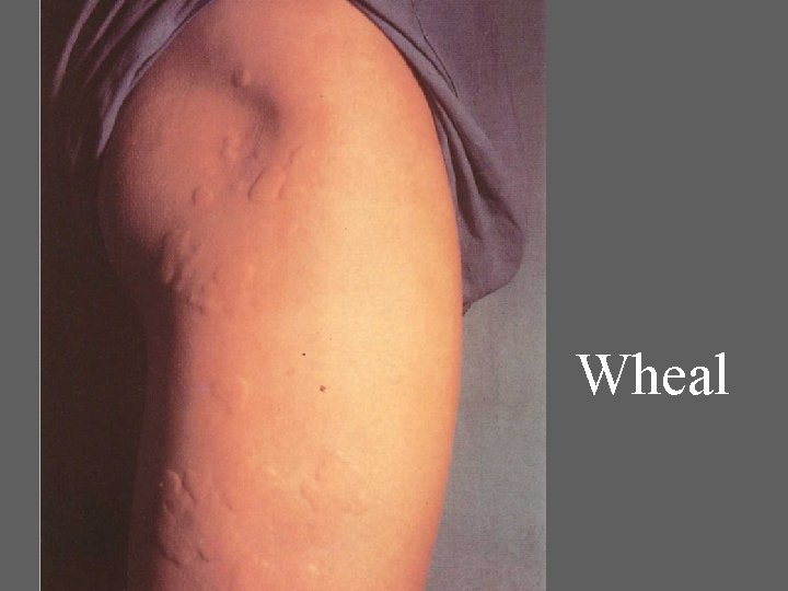 Urticaria Definition URticaria is an extremely common allergic