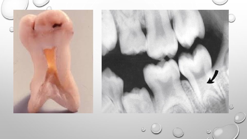 TAURODONTISM ITS A MORPHOANATOMICAL CHANGE IN THE SHAPE