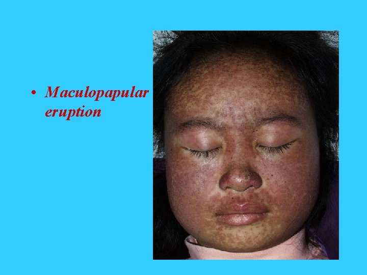 Systemic Lupus Erythematosus BY DR SHARMEEN TALPUR Definition