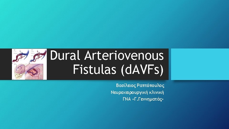 Definition Abnormal arteriovenous shunts within the dural leaflets