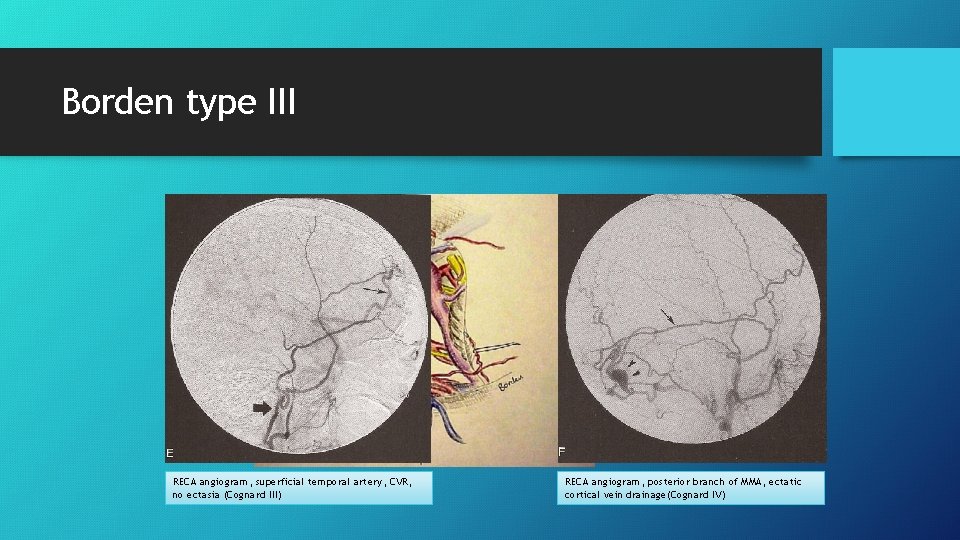 Definition Abnormal arteriovenous shunts within the dural leaflets