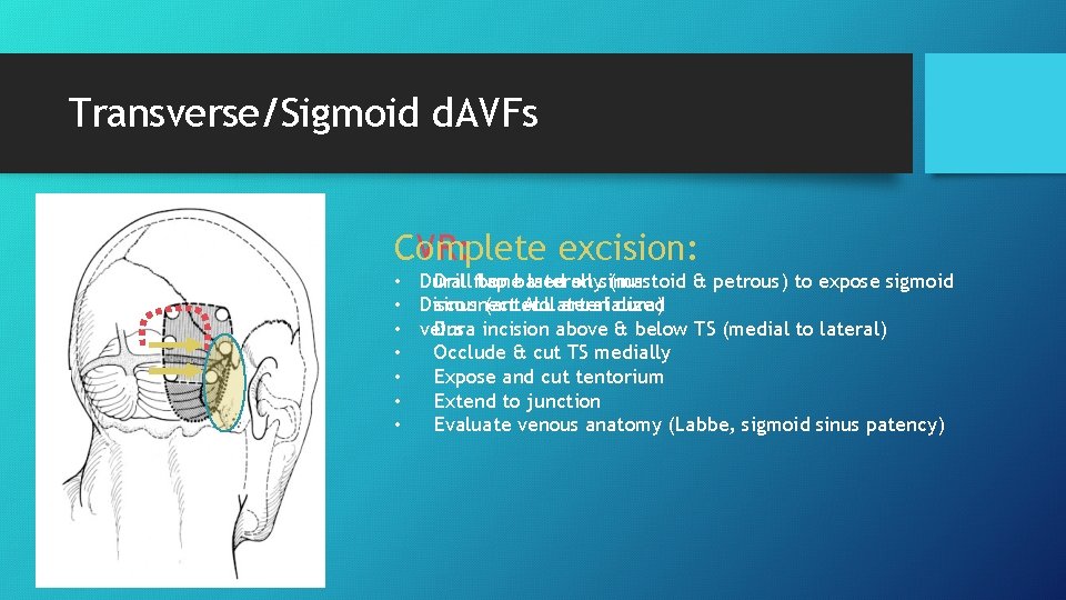 Definition Abnormal arteriovenous shunts within the dural leaflets