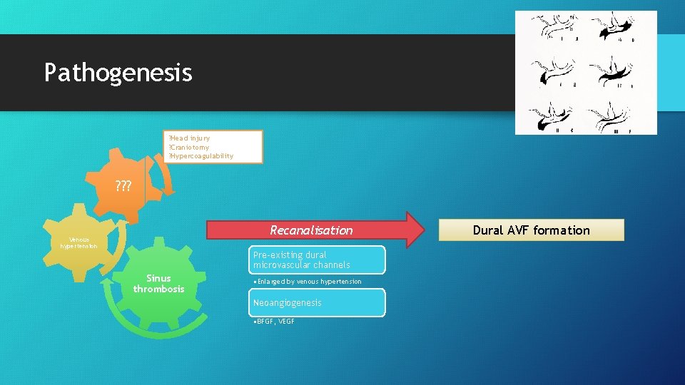 Definition Abnormal arteriovenous shunts within the dural leaflets