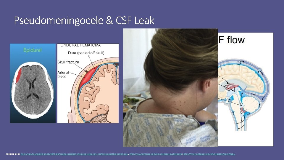 Case Presentation Vestibular Schwannoma VP shunt NCLIN 411