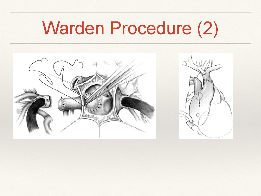 UCSF Congenital Cardiac Anesthesia Tutorials VSDs and ASDs