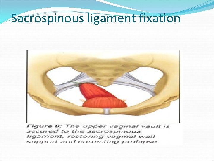 Definitions of Prolapse ANTERIOR Anterior Wall Defect AKA