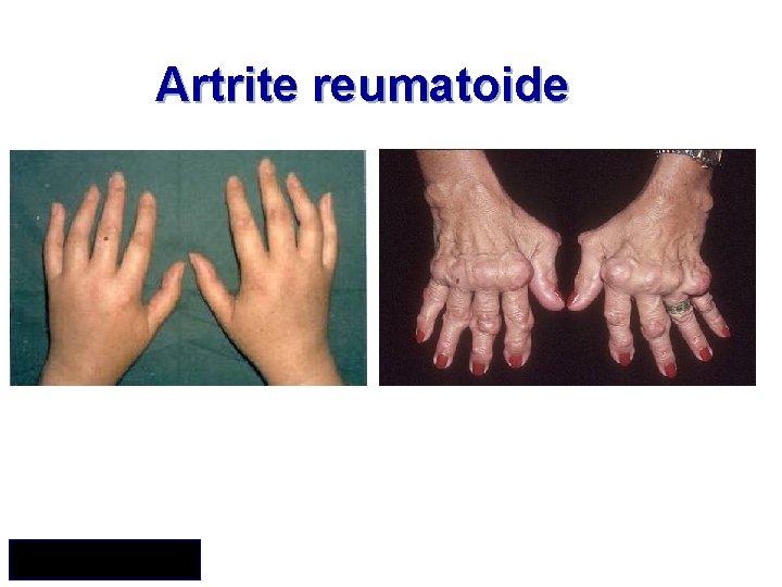Artrite reumatoide Artrite reumatoide Malattia infiammatoria cronica ...
