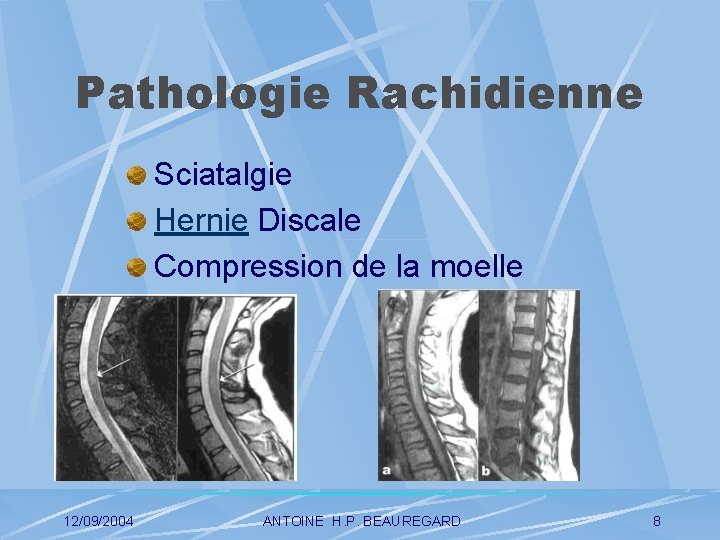 12092004 ANTOINE H P BEAUREGARD 1 La neuroradiologie