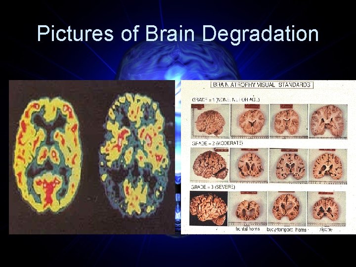 Alzheimers Disease By Ryan Triplett Alzheimers The deterioration