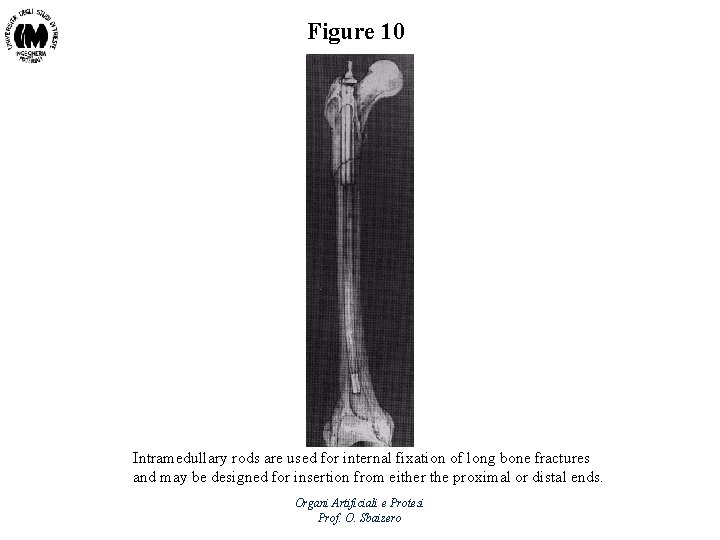 Fracture Fixation Fracture Fixation Casts Wires Pins Screws