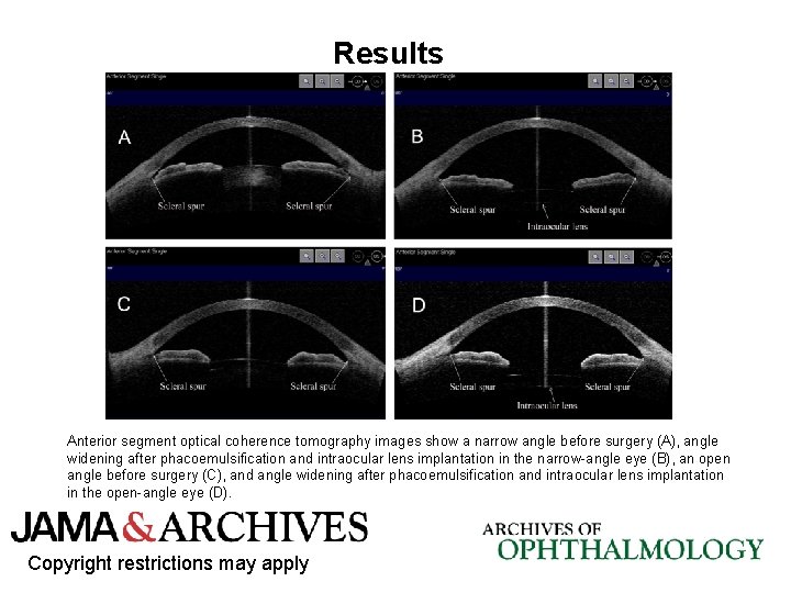 Anterior Chamber Depth Iridocorneal Angle Width and Intraocular