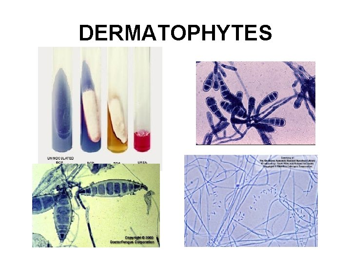 Cutaneous Fungal Infections o Dermatophytosis ringworm disease of
