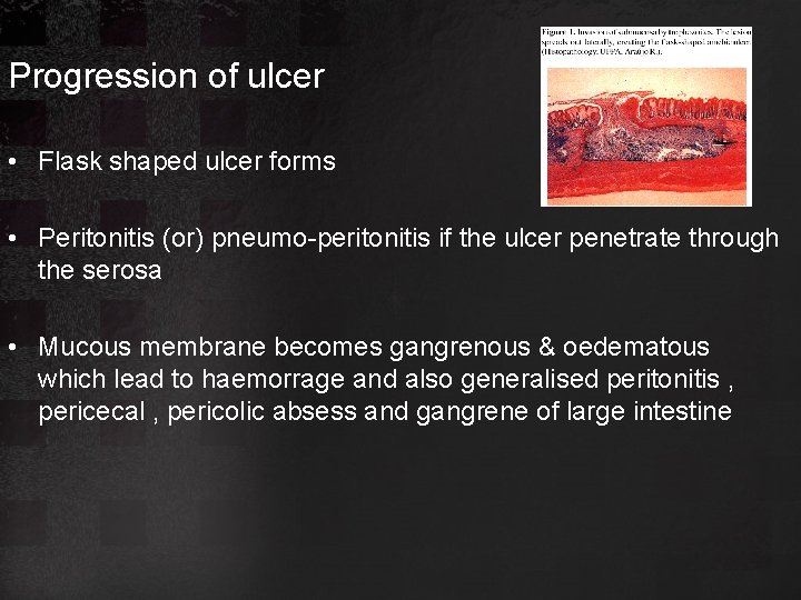 E Histolytica Pathogenesis pathology E Histolytica can effect