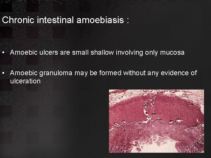 E Histolytica Pathogenesis pathology E Histolytica can effect
