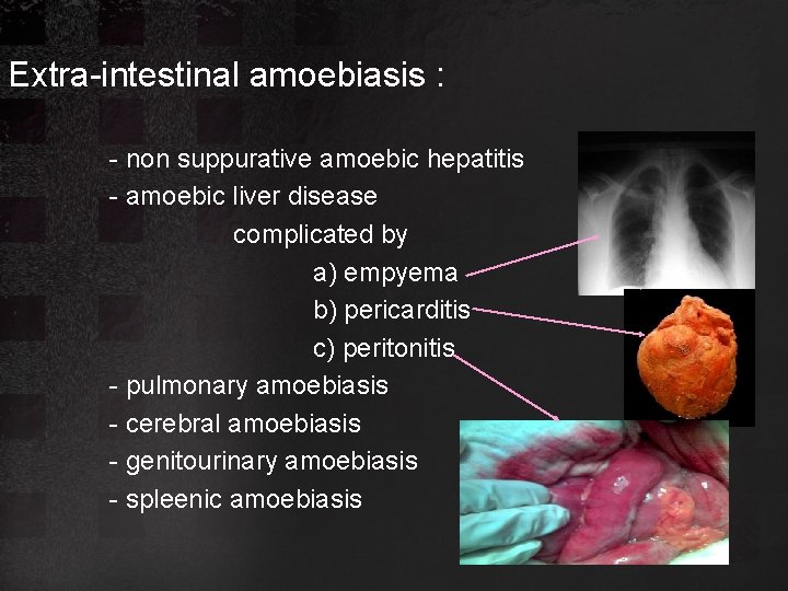 E Histolytica Pathogenesis pathology E Histolytica can effect