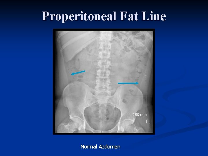RADIOLOGY REVIEW Plain films of abdomen ABDOMEN Soft