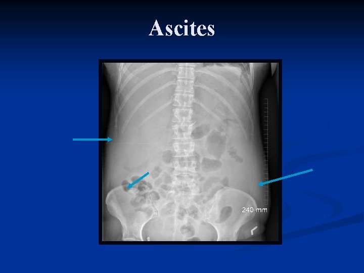 RADIOLOGY REVIEW Plain films of abdomen ABDOMEN Soft
