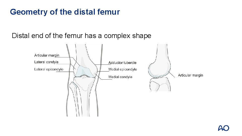 Distal femoral fractures treatment options and outcomes AO