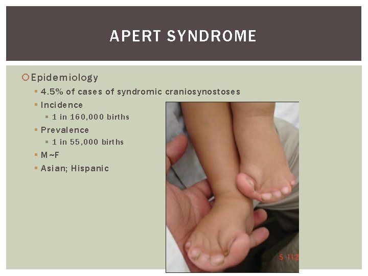 CRANIOSYNOSTOSIS A CASE OF APERT SYNDROME Victoria Schunemann