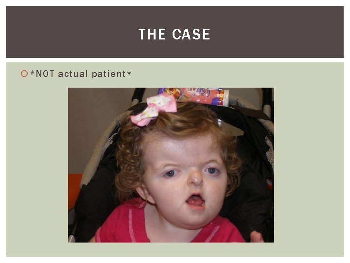 CRANIOSYNOSTOSIS A CASE OF APERT SYNDROME Victoria Schunemann
