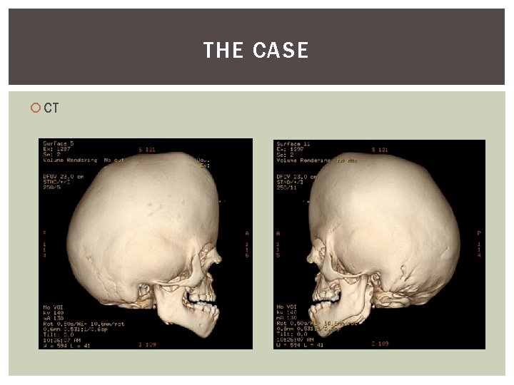 CRANIOSYNOSTOSIS A CASE OF APERT SYNDROME Victoria Schunemann