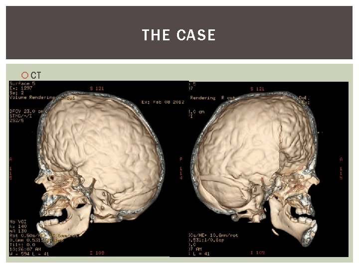 CRANIOSYNOSTOSIS A CASE OF APERT SYNDROME Victoria Schunemann