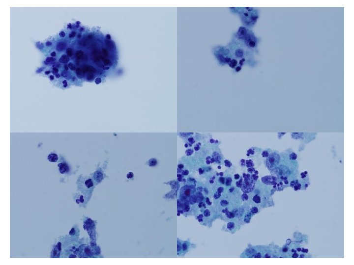 Single bipolar nuclei Cytologic Findings Cellularity low Nucleus