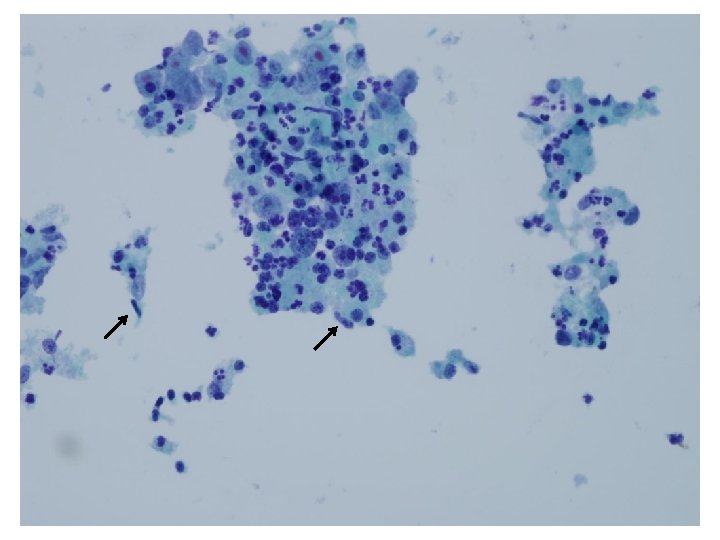 Single bipolar nuclei Cytologic Findings Cellularity low Nucleus