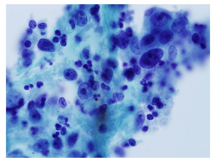 Single bipolar nuclei Cytologic Findings Cellularity low Nucleus