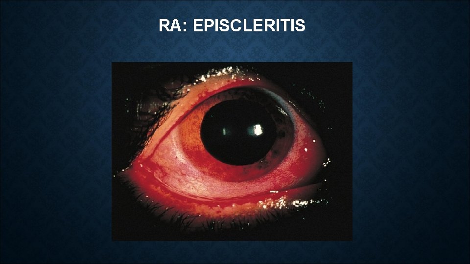 RHEUMATOID ARTHRITIS Sam R Dalvi MD Associate Professor