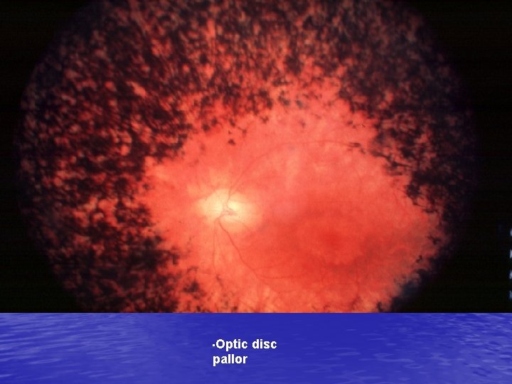 Retinitis pigmentosa Presenter SAAD ALDAHMASH MD Background Retinitis