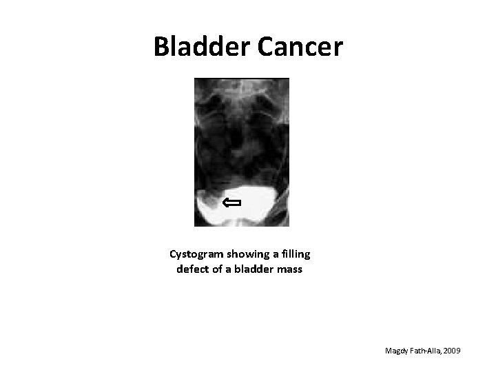 Bladder Cancer Magdy FathAlla 2009 Bladder Cancer Introduction
