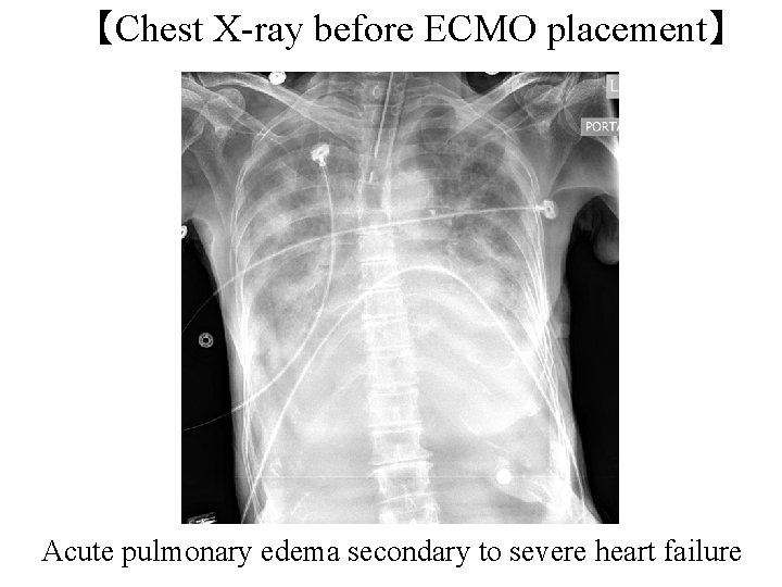 Extracorporeal Membrane Oxygenation for Bridge to Decision and