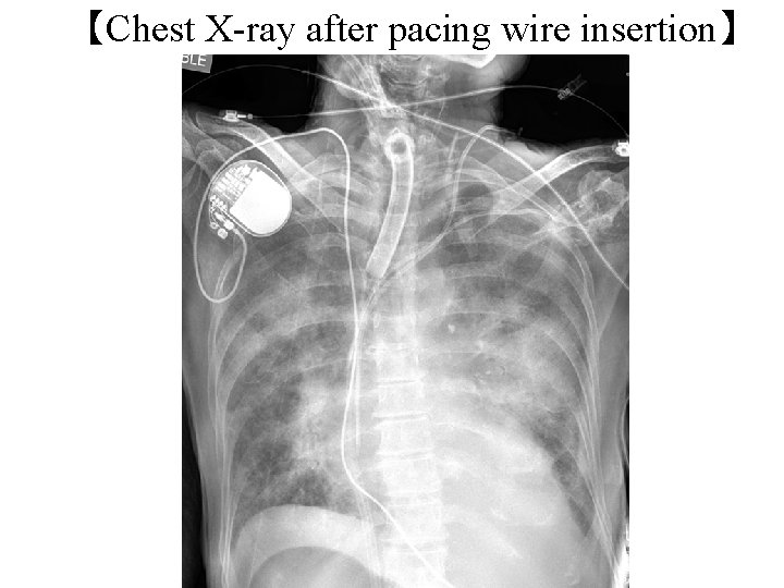 Extracorporeal Membrane Oxygenation for Bridge to Decision and