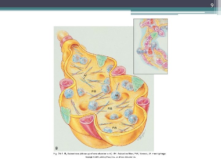 1 Pneumoconiosis By Molly Smith 2 Interstitial Lung