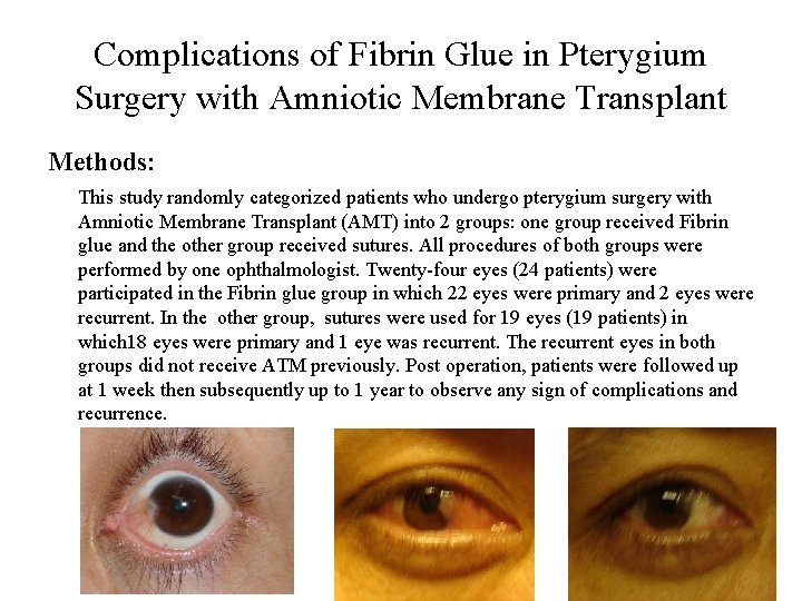 Complications of Fibrin Glue in Pterygium Surgery with