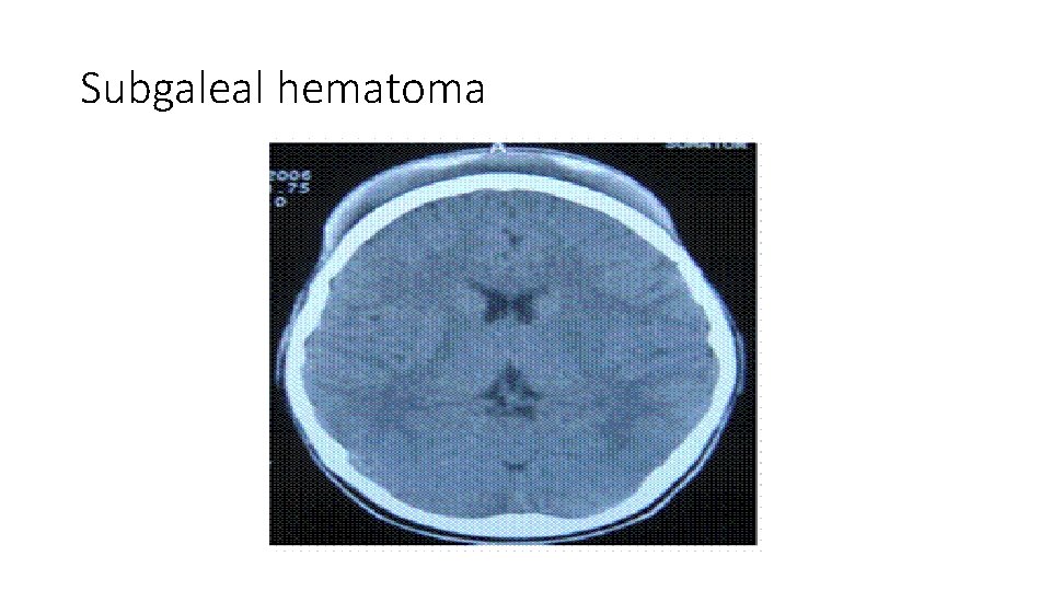 Head Injury Done By Mohammad Badwan Abdelrahman Bdeir