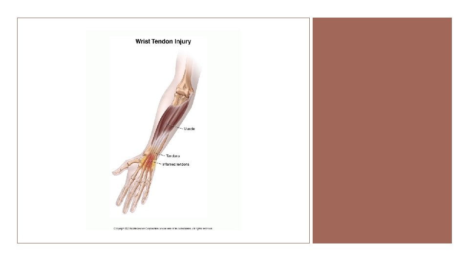 MUSCLE AND TENDON INJURIES ELBOW FLEXOR STRAINS Strains