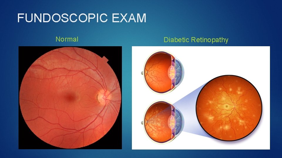 DIABETIC RETINOPATHY FLAME LECTURE 13 MARSHBURN 10 29