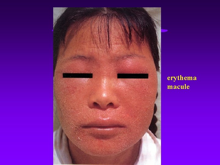 Contact Dermatitis Definition An inflammatory reaction resulting from