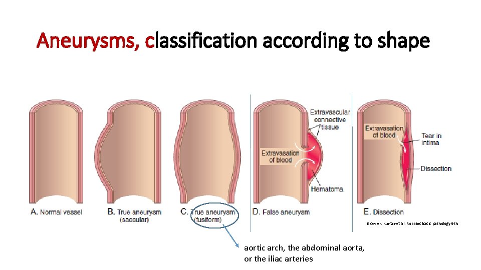Aneurysms a Brief Discussion on Embolism Ali Al