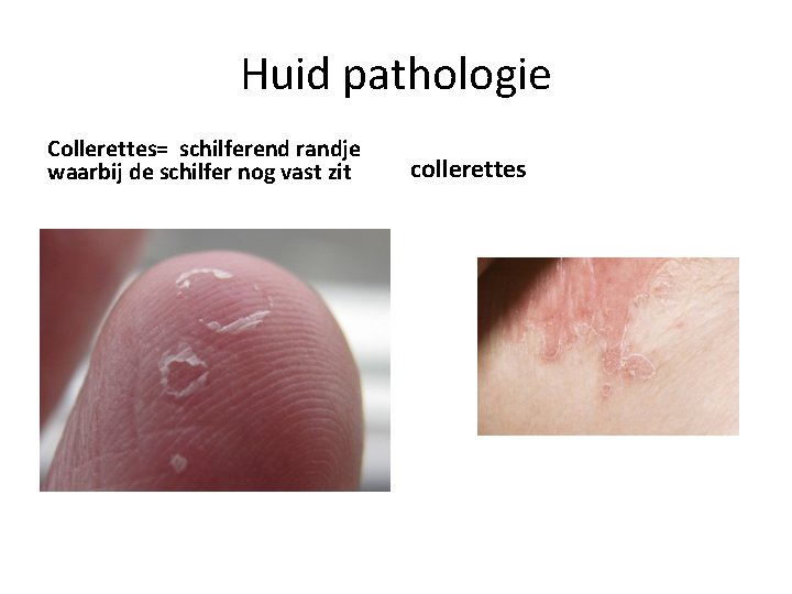 Huid pathologie Huid pathologie alopecia Alopecia kaalheid Huid