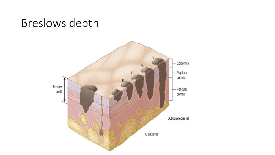 Disorders of Melanocytes Benign lesionsMelanoma Dr Vishal Mago