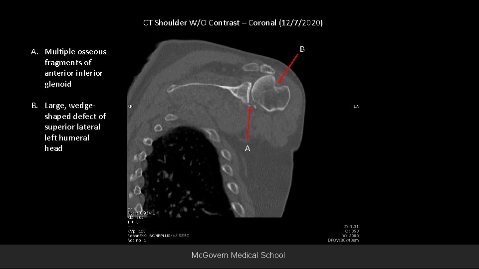 Shoulder Dislocation with Bony Defects Sahira Farooq 1292020