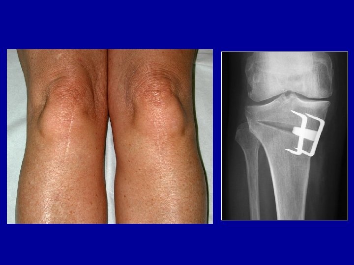 La gonarthrose LA GONARTHROSE Arthrose du genou Arthrose