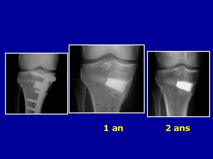 La gonarthrose LA GONARTHROSE Arthrose du genou Arthrose