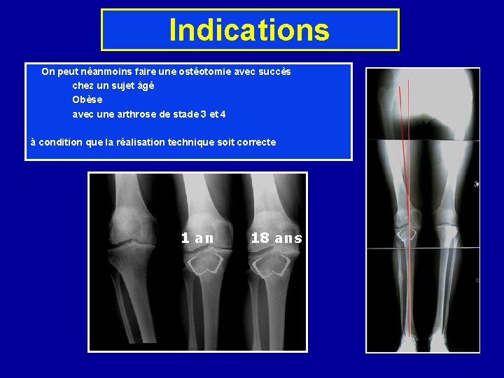 La gonarthrose LA GONARTHROSE Arthrose du genou Arthrose