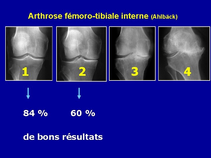 La gonarthrose LA GONARTHROSE Arthrose du genou Arthrose