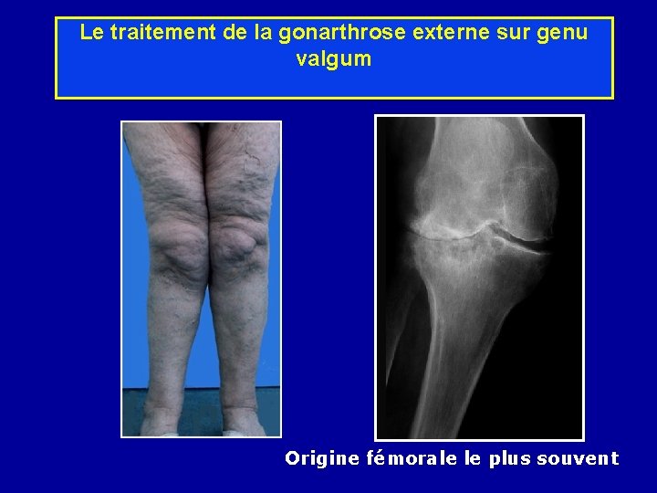 La gonarthrose LA GONARTHROSE Arthrose du genou Arthrose