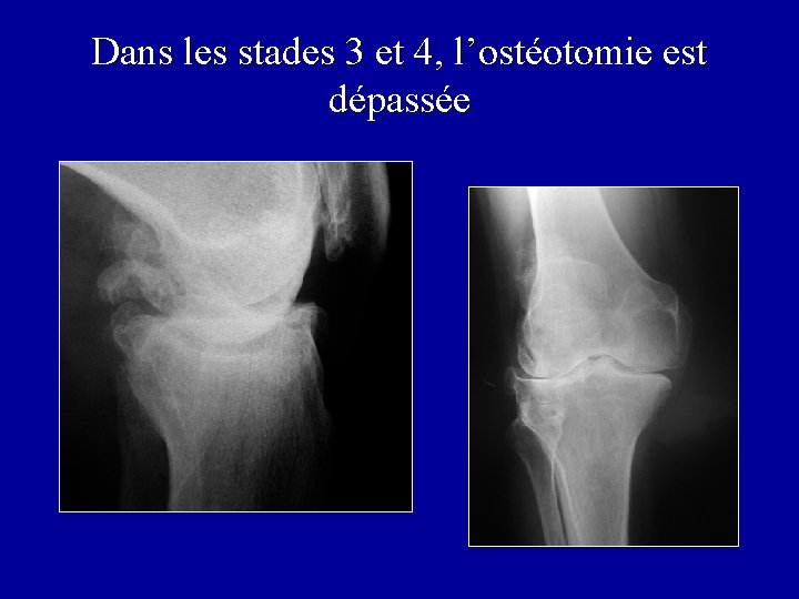 La gonarthrose LA GONARTHROSE Arthrose du genou Arthrose